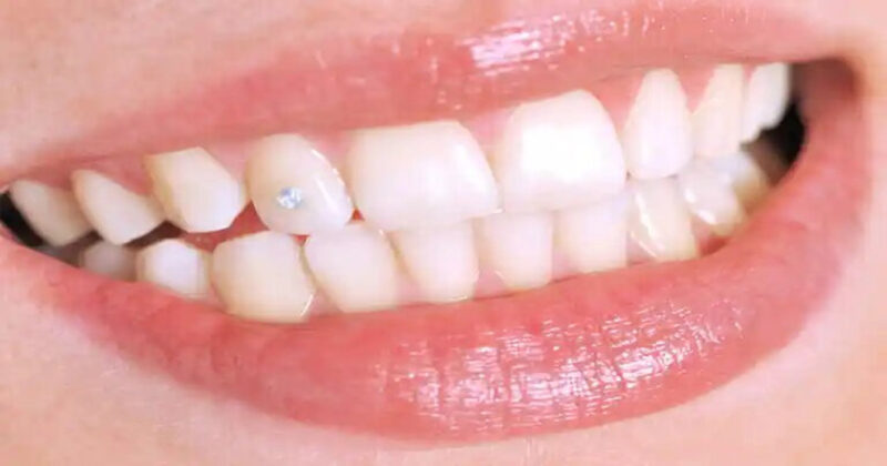 Put a jewel in your teeth - Barcelona Clinica dental Les Corts